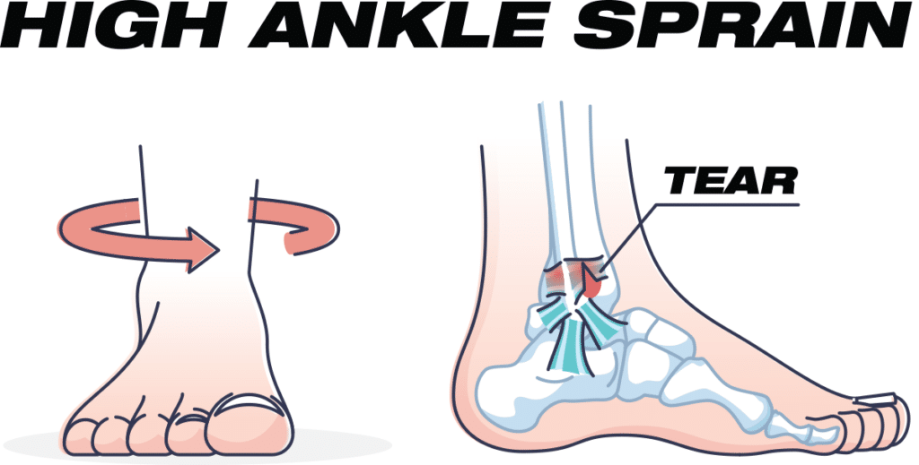 High Ankle Sprain - Ultra Ankle | Ultra Ankle