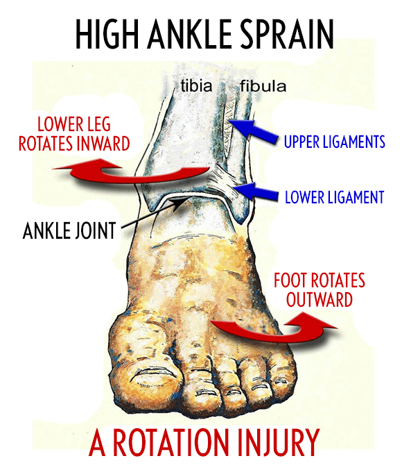 Diagnosing and Treating High Ankle Sprains - Ultra Ankle | Ultra Ankle